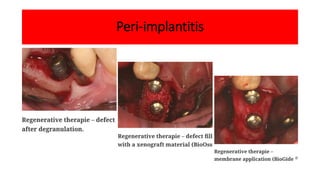 Peri-implant Diseases Classification, Cases Definition and Treatment.pdf