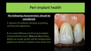 Peri-implant Diseases Classification, Cases Definition and Treatment.pdf