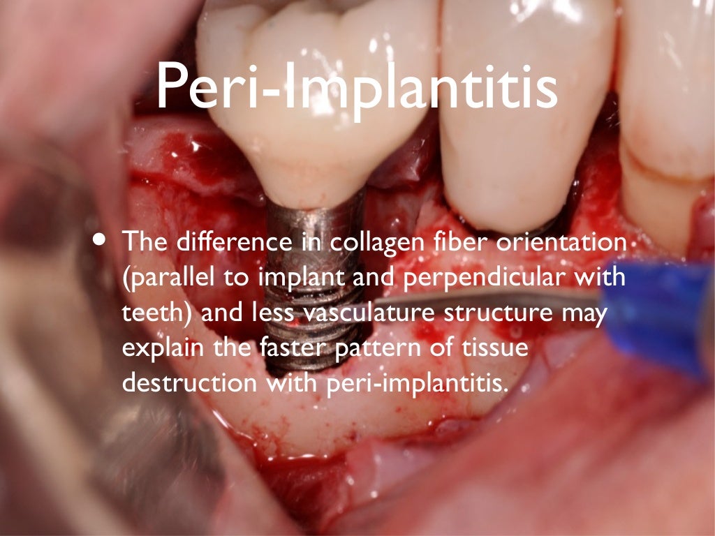 Peri implantitis