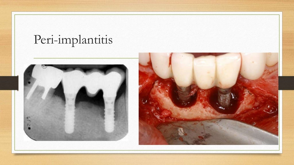 Peri implantitis