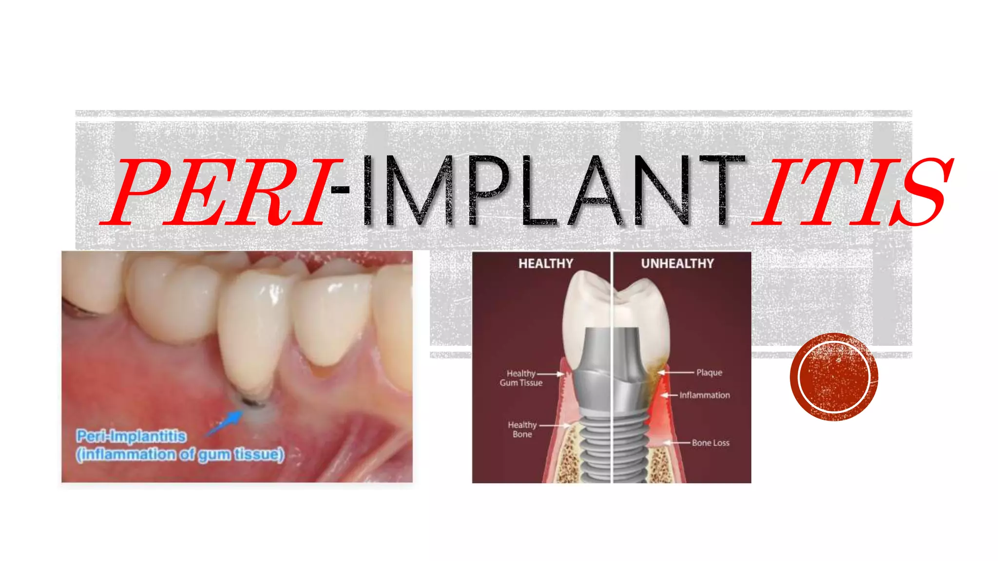 Peri implantitis | PPTX