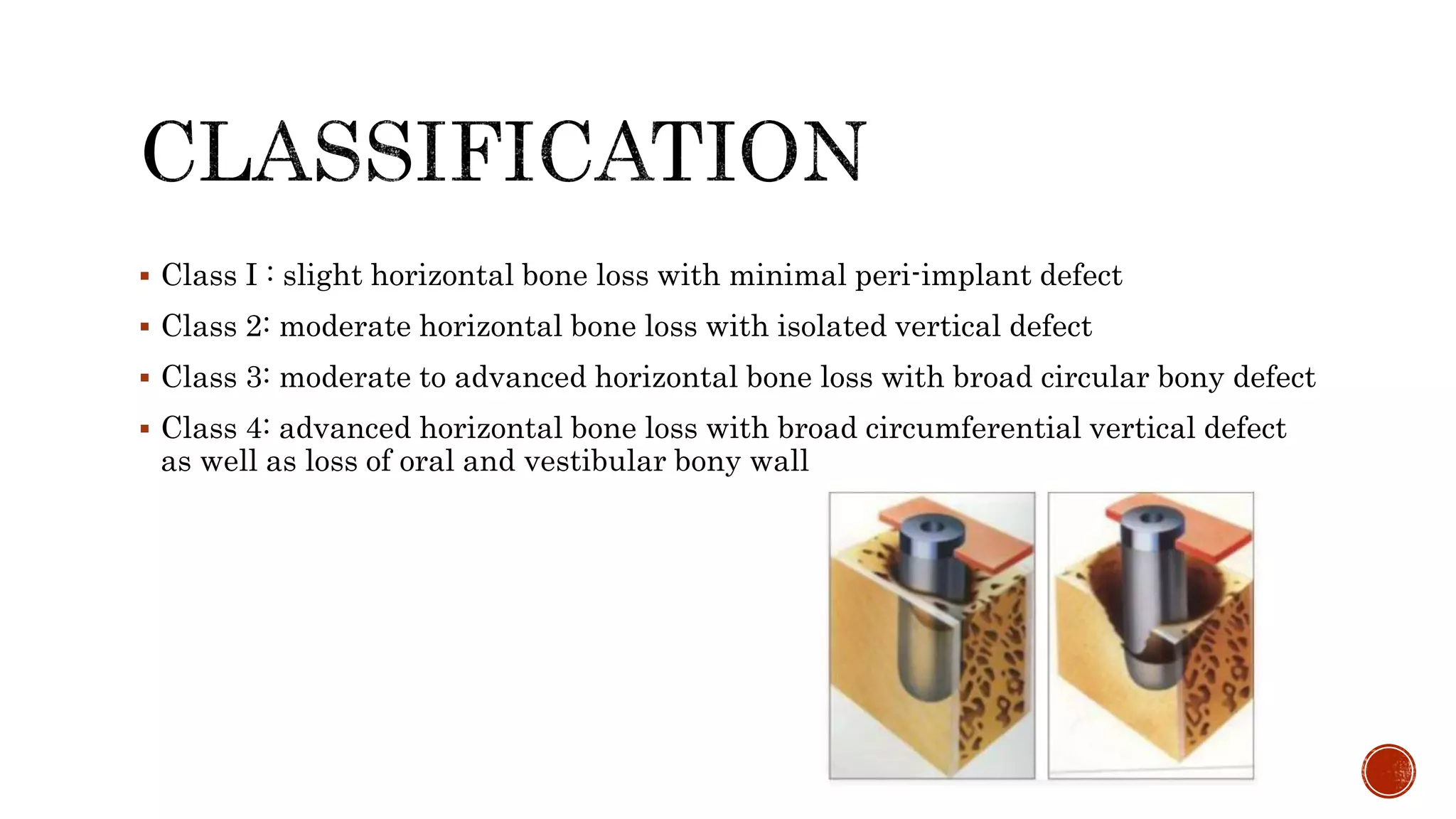 Peri implantitis | PPTX