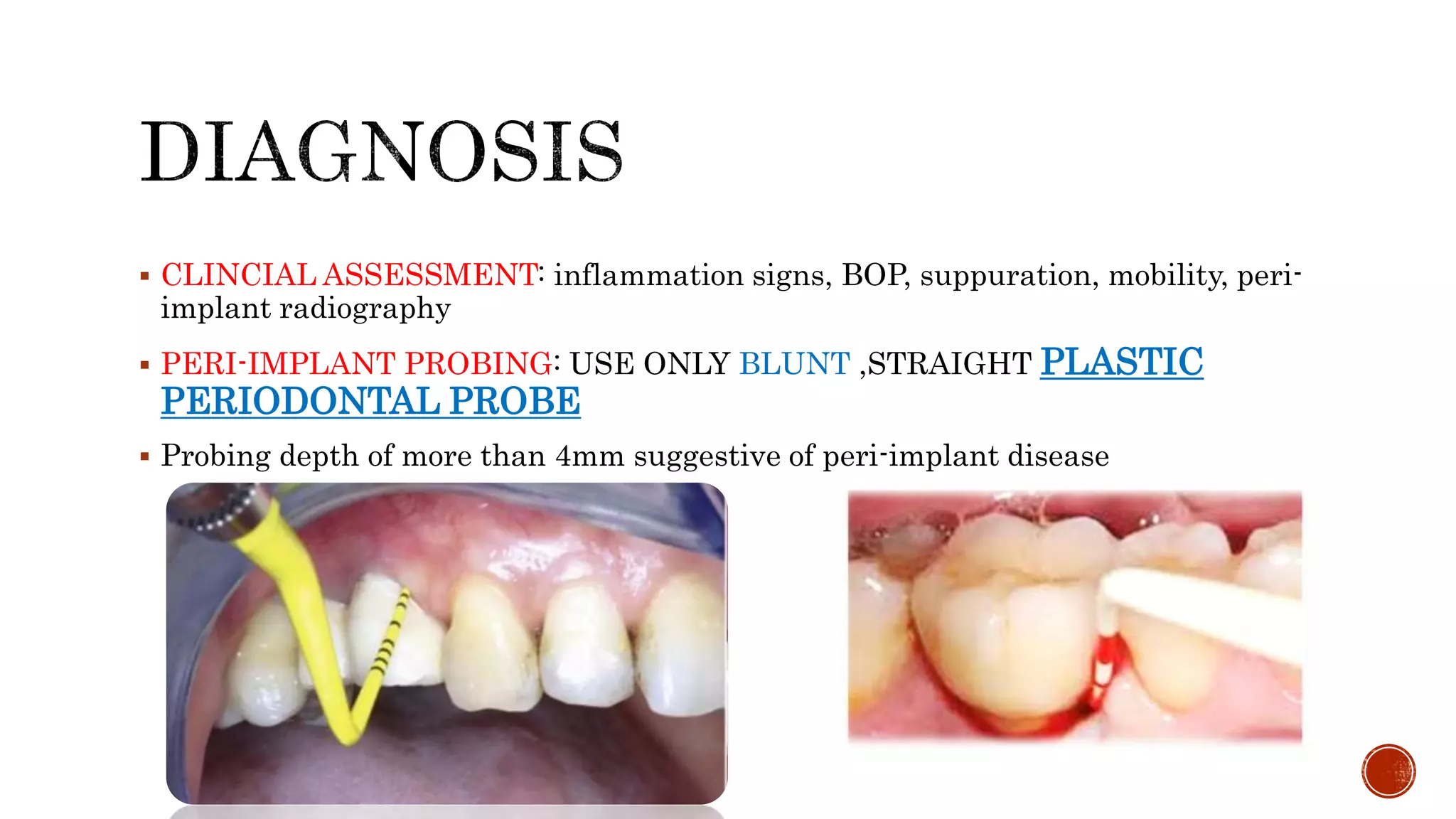 Peri implantitis | PPTX