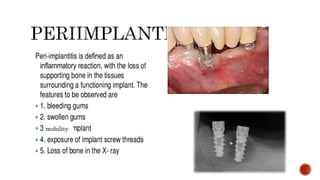 Peri implantitis | PPTX