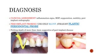 Peri implantitis | PPTX