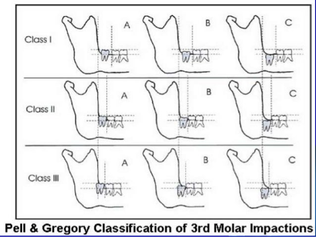 Impacted third molar management