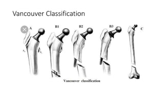 Peri prosthetic fractures | PPTX