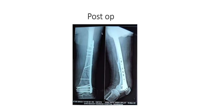 Peri prosthetic fractures | PPTX