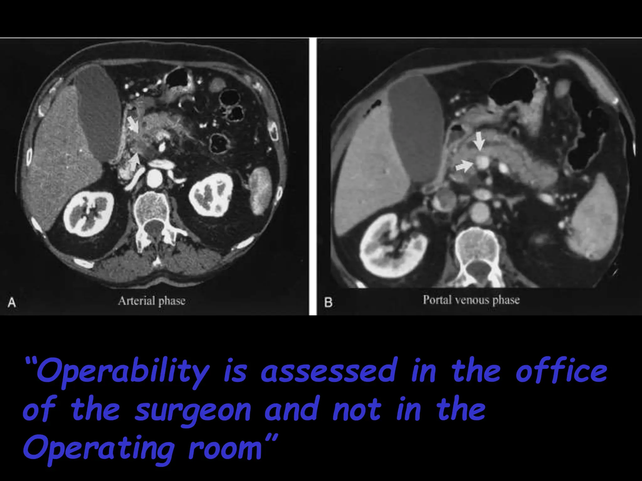 Periampullary CArcinoma .PPT.pptx download | PPTX