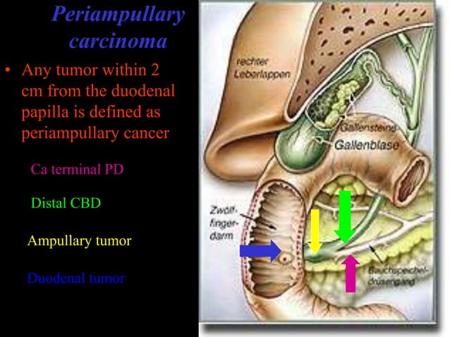 Periampullary CArcinoma .PPT.pptx download | PPTX