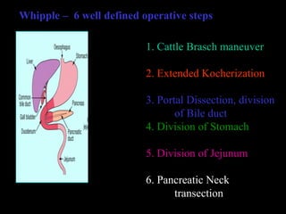Periampullary CArcinoma .PPT.pptx download | PPTX