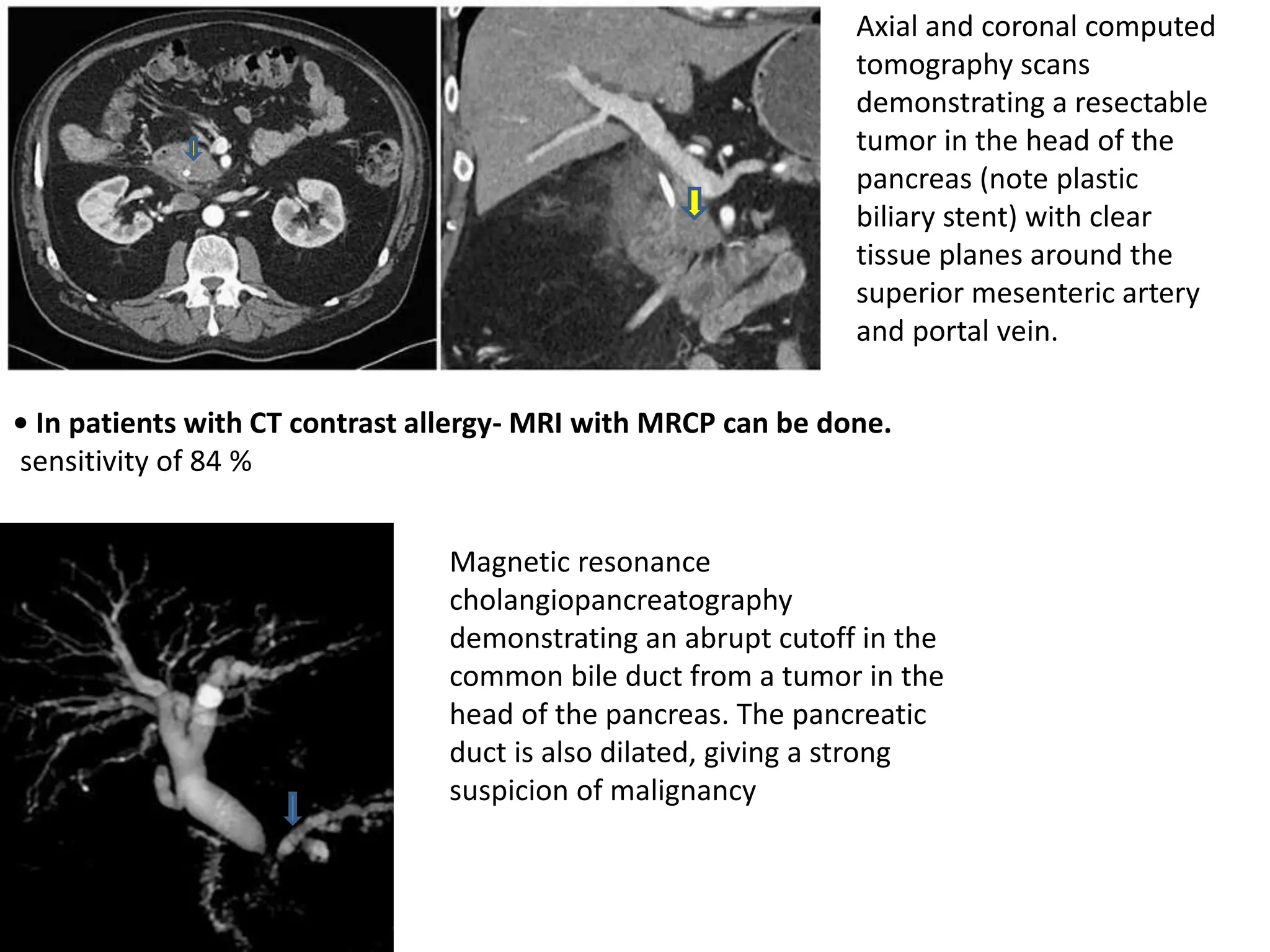 Periampullary_carcinoma_–diagnosis_with_staging,_preoperative (2).pptx