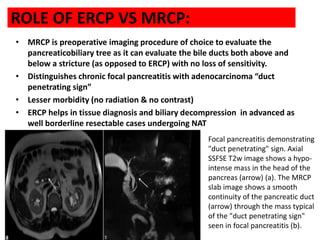 Periampullary_carcinoma_–diagnosis_with_staging,_preoperative (2).pptx