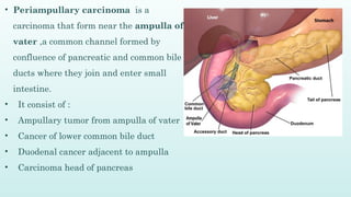 periampullary carcinoma for surgery residents | PPTX
