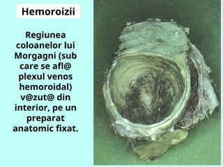 Patologia regiunii perianale (hemoroizi, fisura anala etc) | PPT