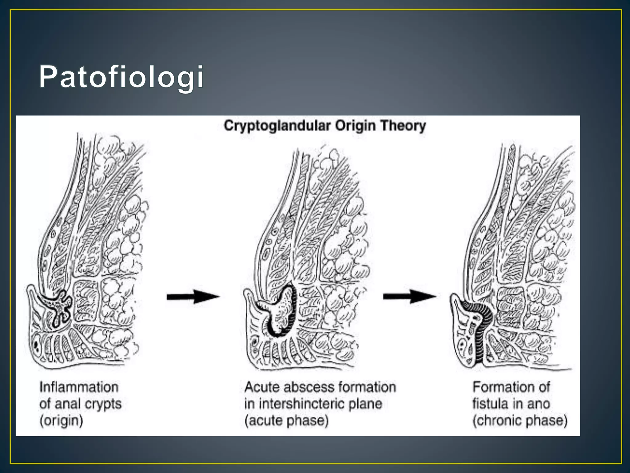 Perianal fistula | PPTX