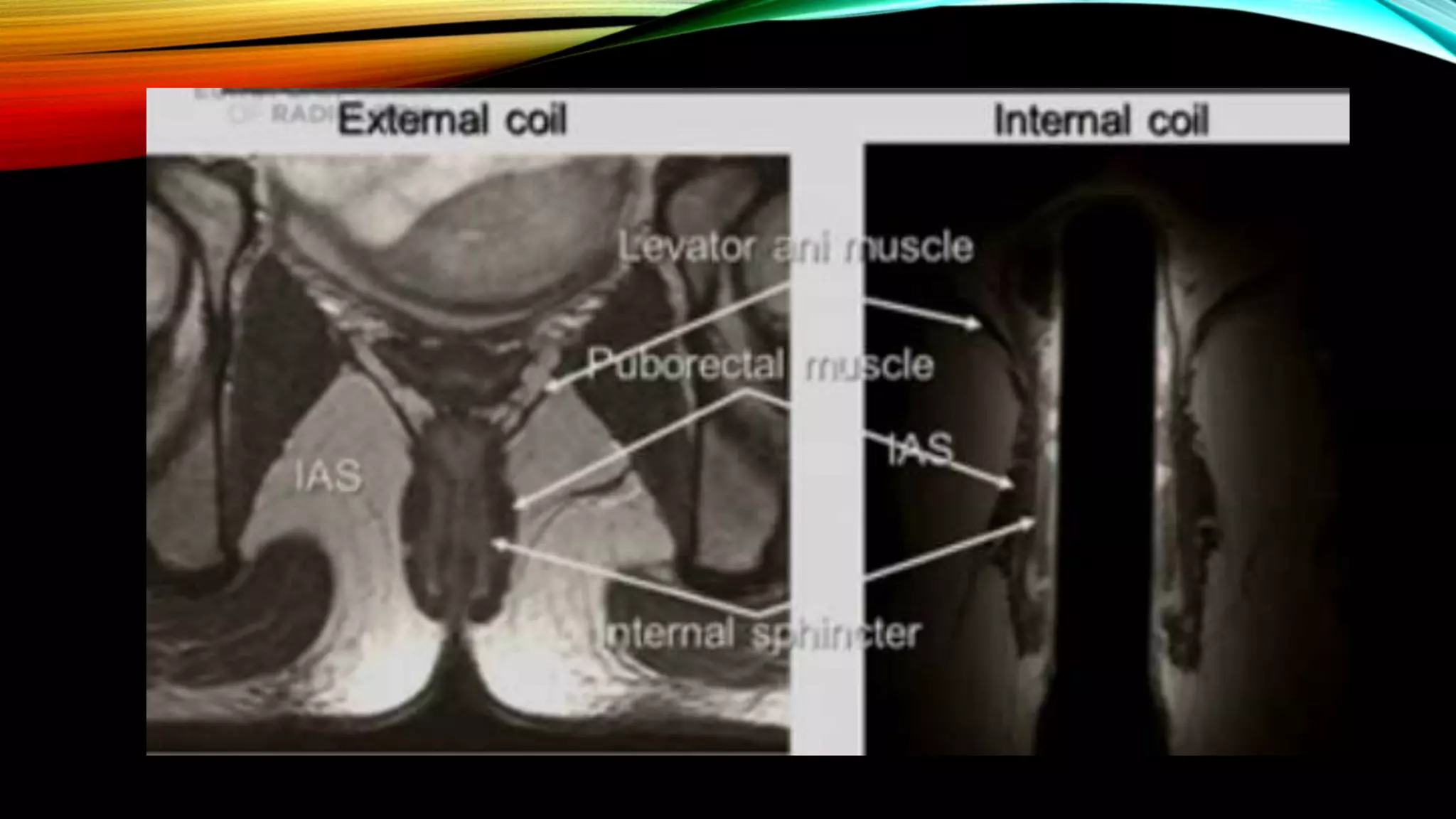 Perianal fistula | PPTX