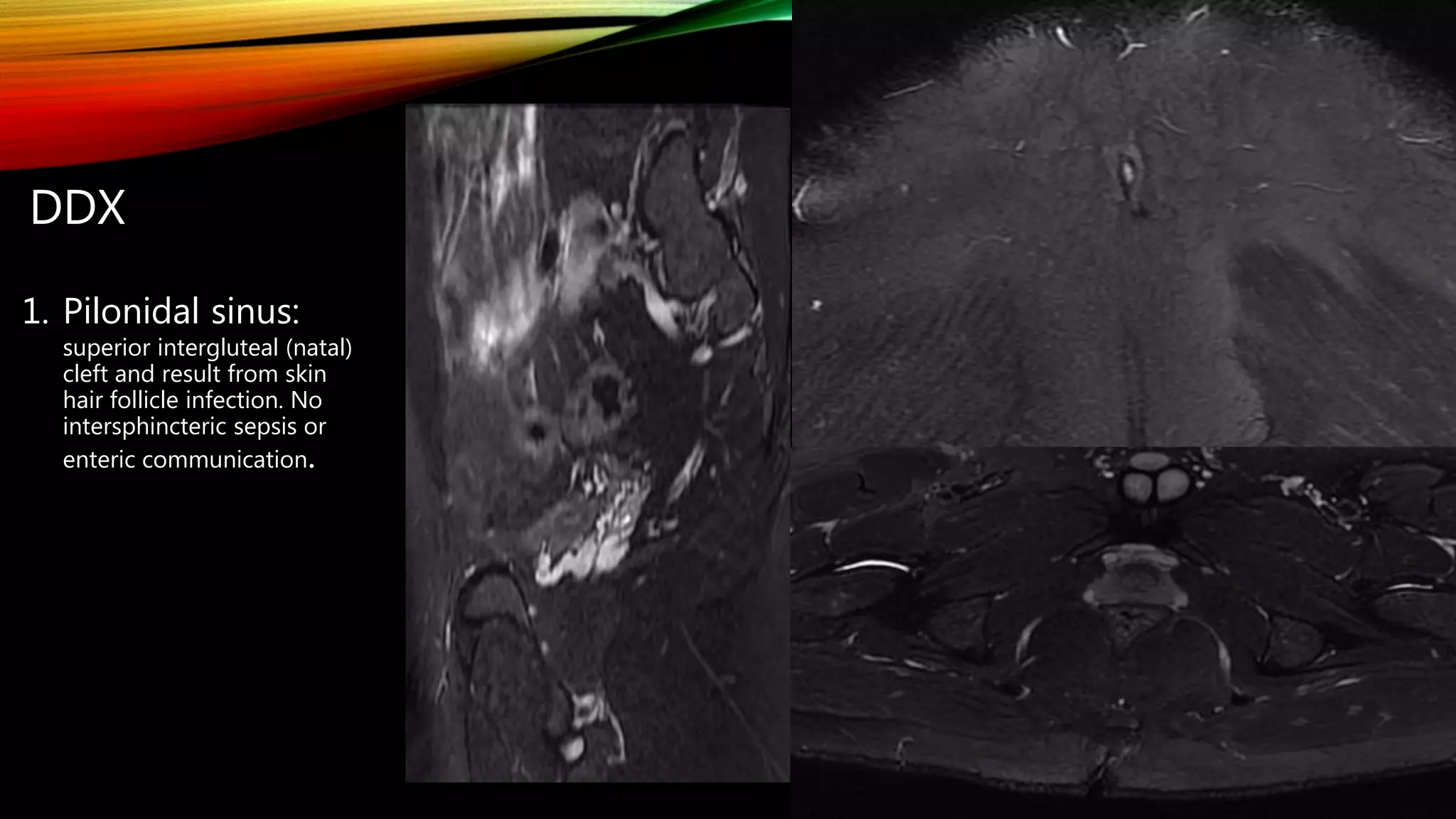 Perianal fistula | PPTX