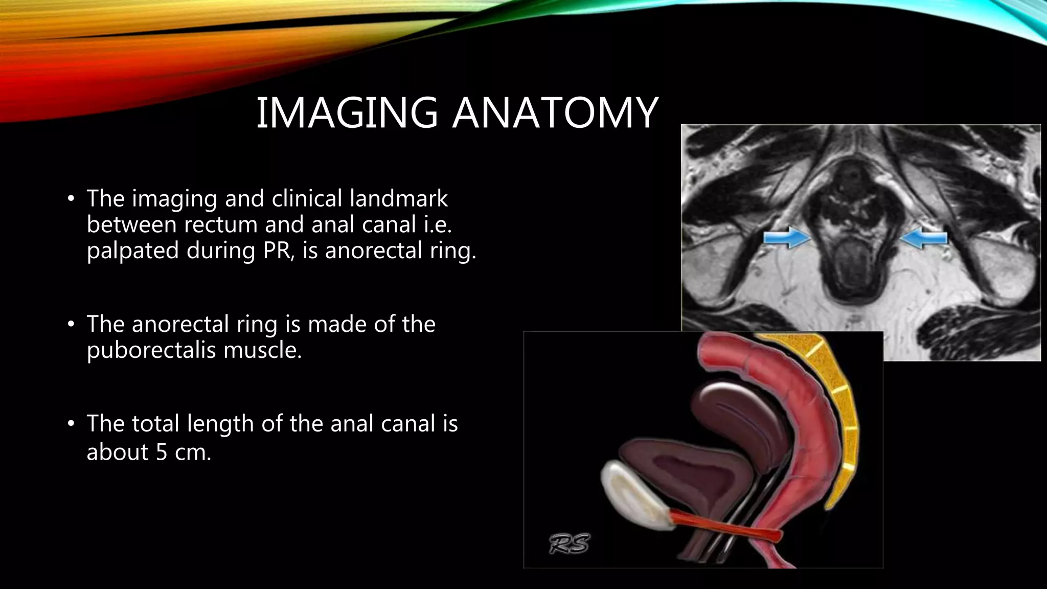 Perianal fistula | PPTX