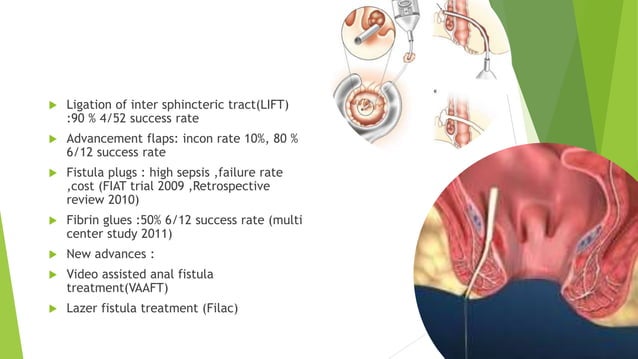 Perianal fistula disease.pptx | Digestive Disorders | Diseases and ...