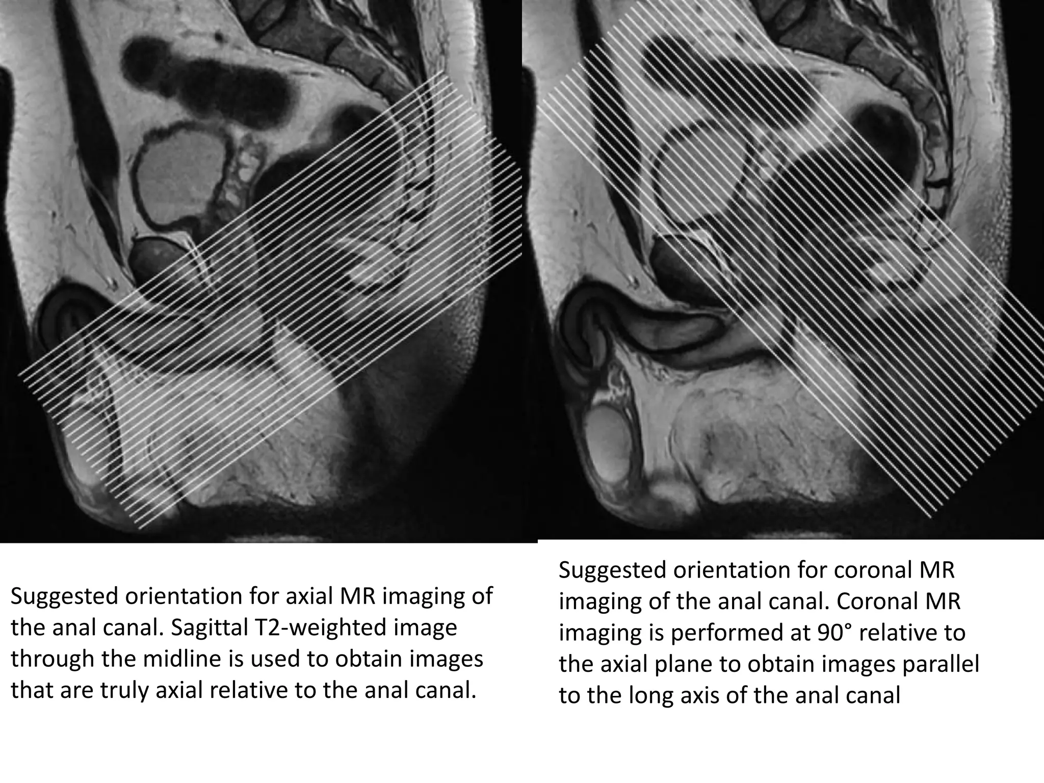 Peri anal fistula mri | PPTX