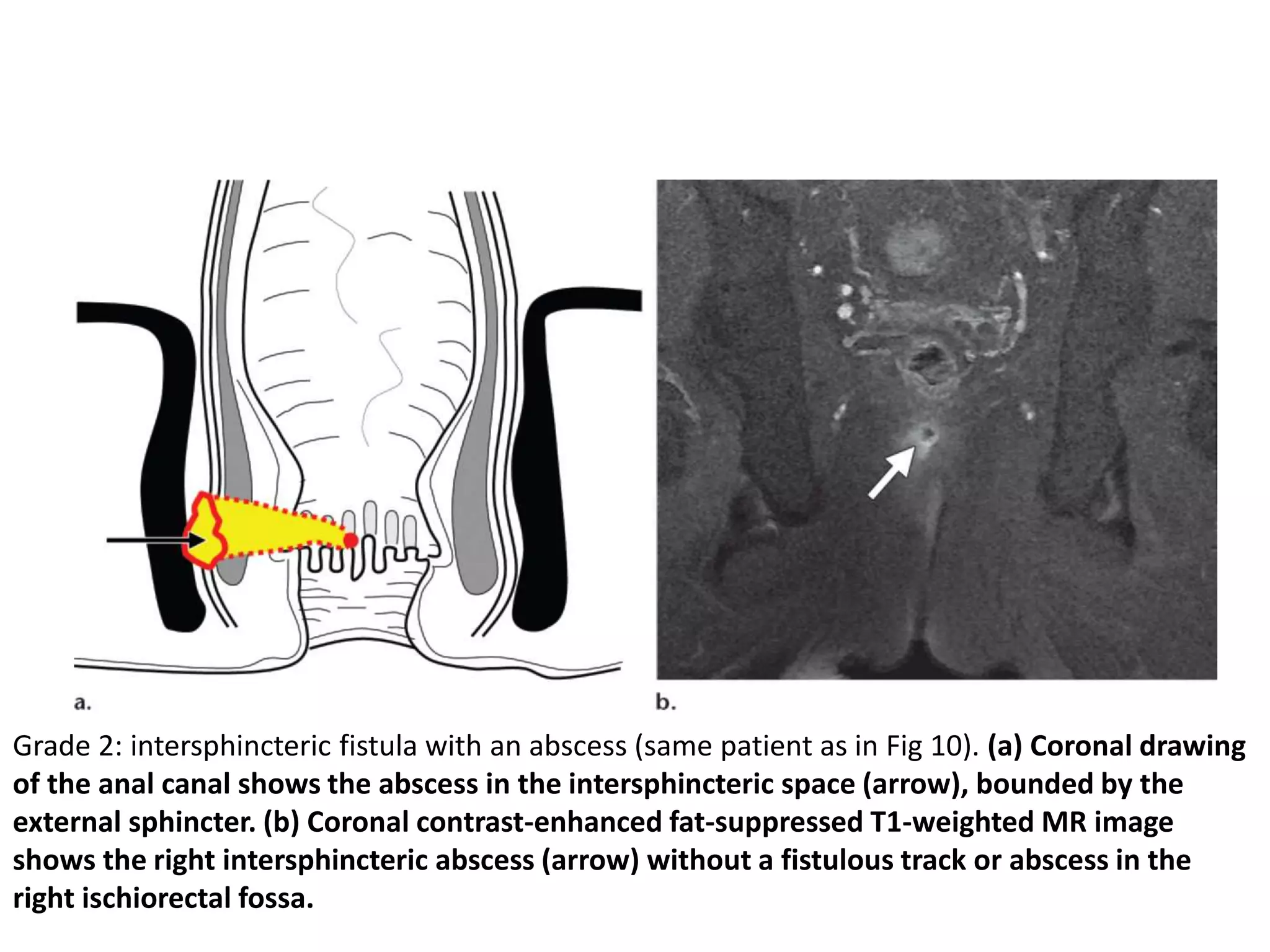 Peri anal fistula mri | PPTX