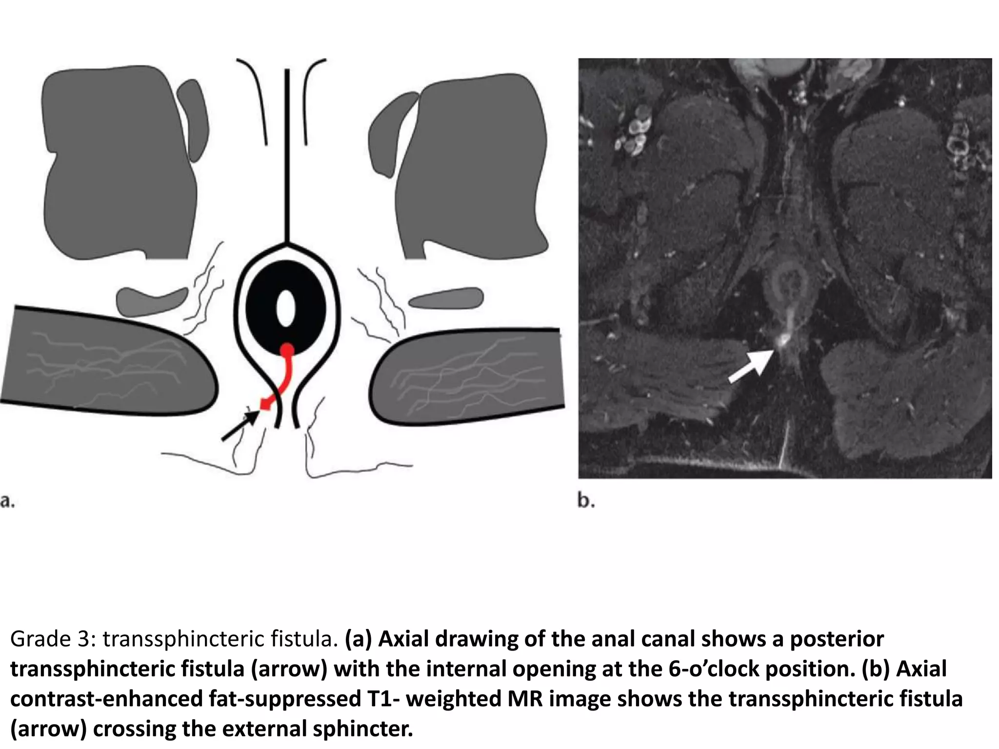 Peri anal fistula mri | PPTX