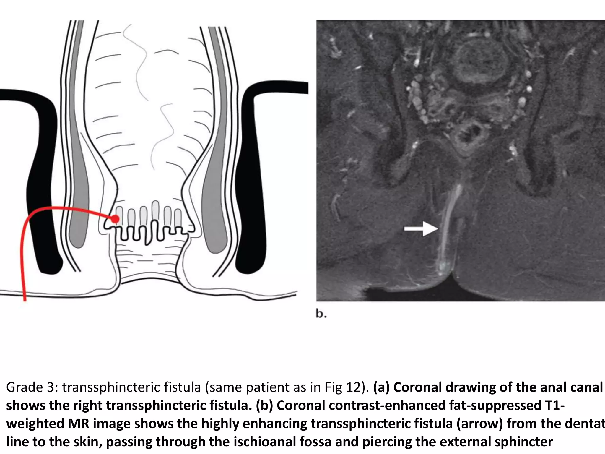 Peri anal fistula mri | PPTX