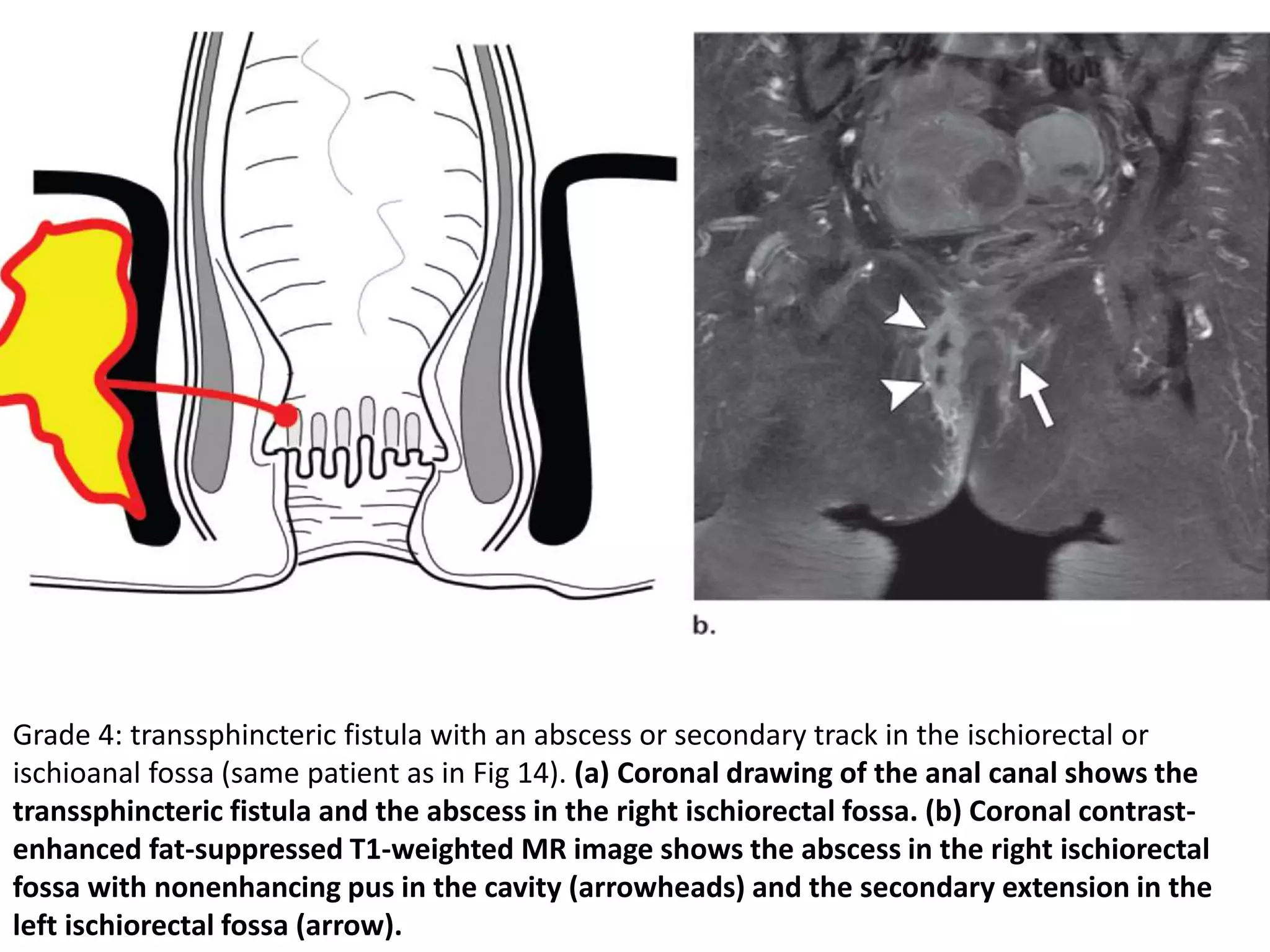 Peri anal fistula mri | PPTX