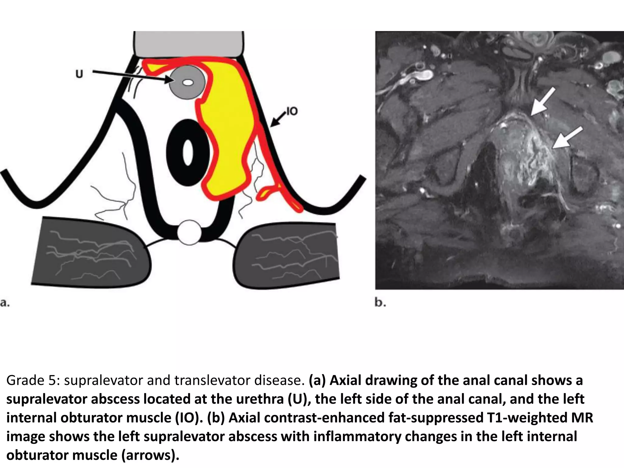 Peri anal fistula mri | PPTX