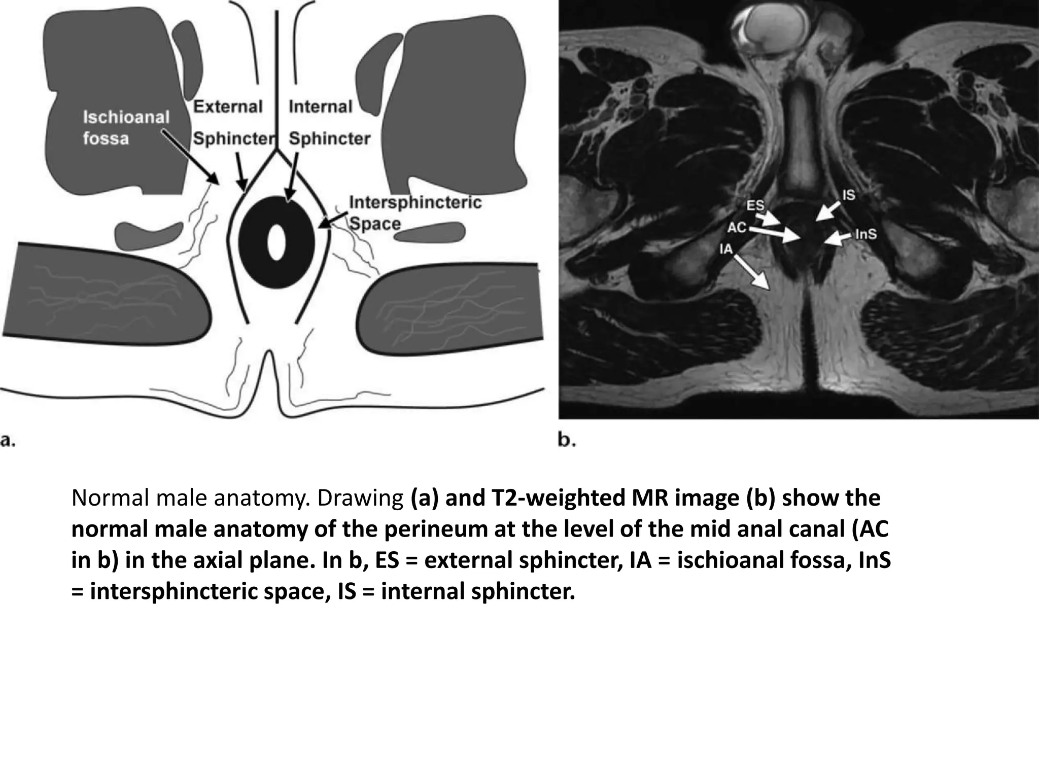 Peri anal fistula mri | PPTX
