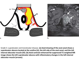 Peri anal fistula mri | PPTX