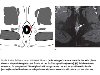 Fistula In Ano Mri