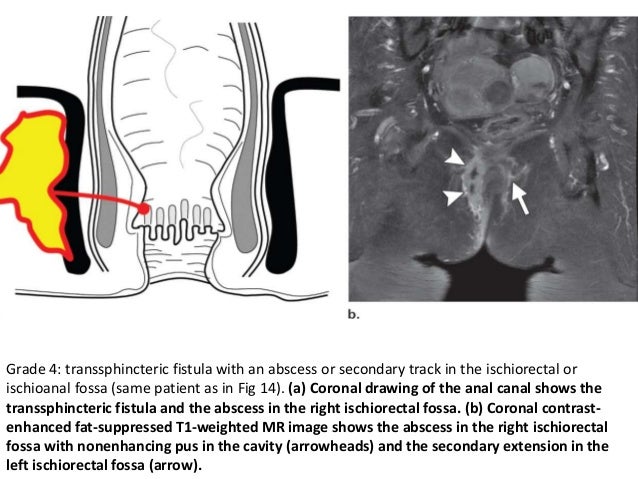 Peri Anal Fistula Mri