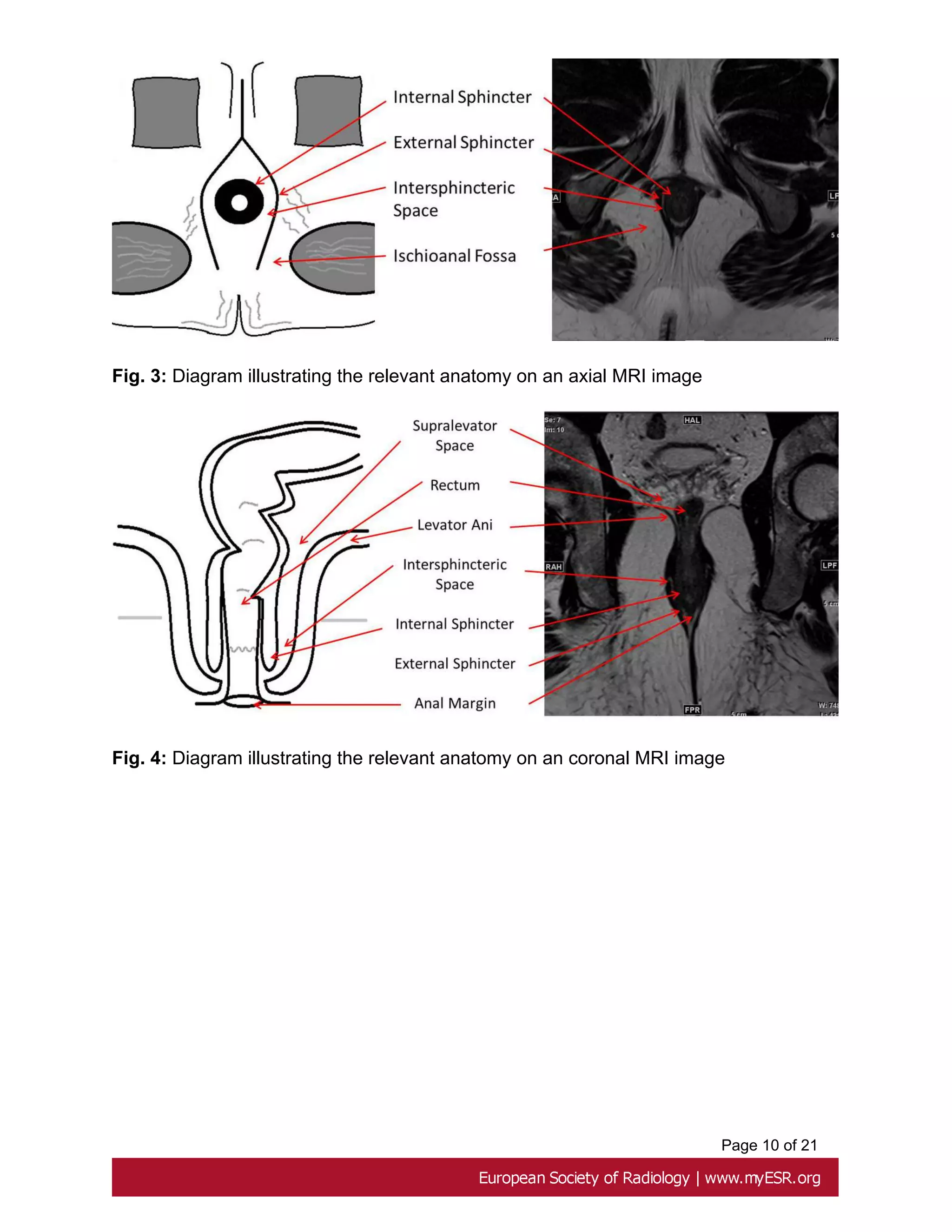 Perianal fistula on mri | PDF