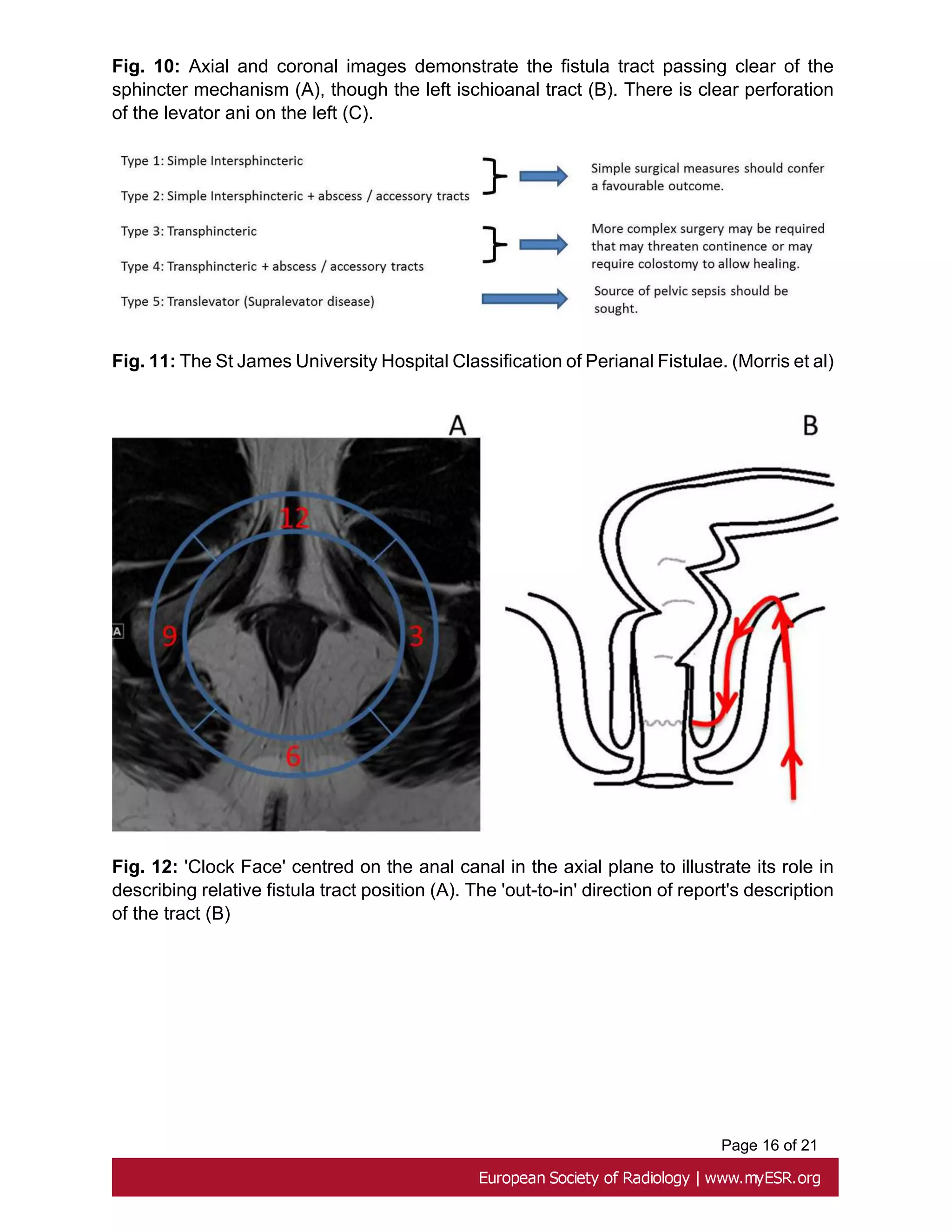 Perianal fistula on mri | PDF