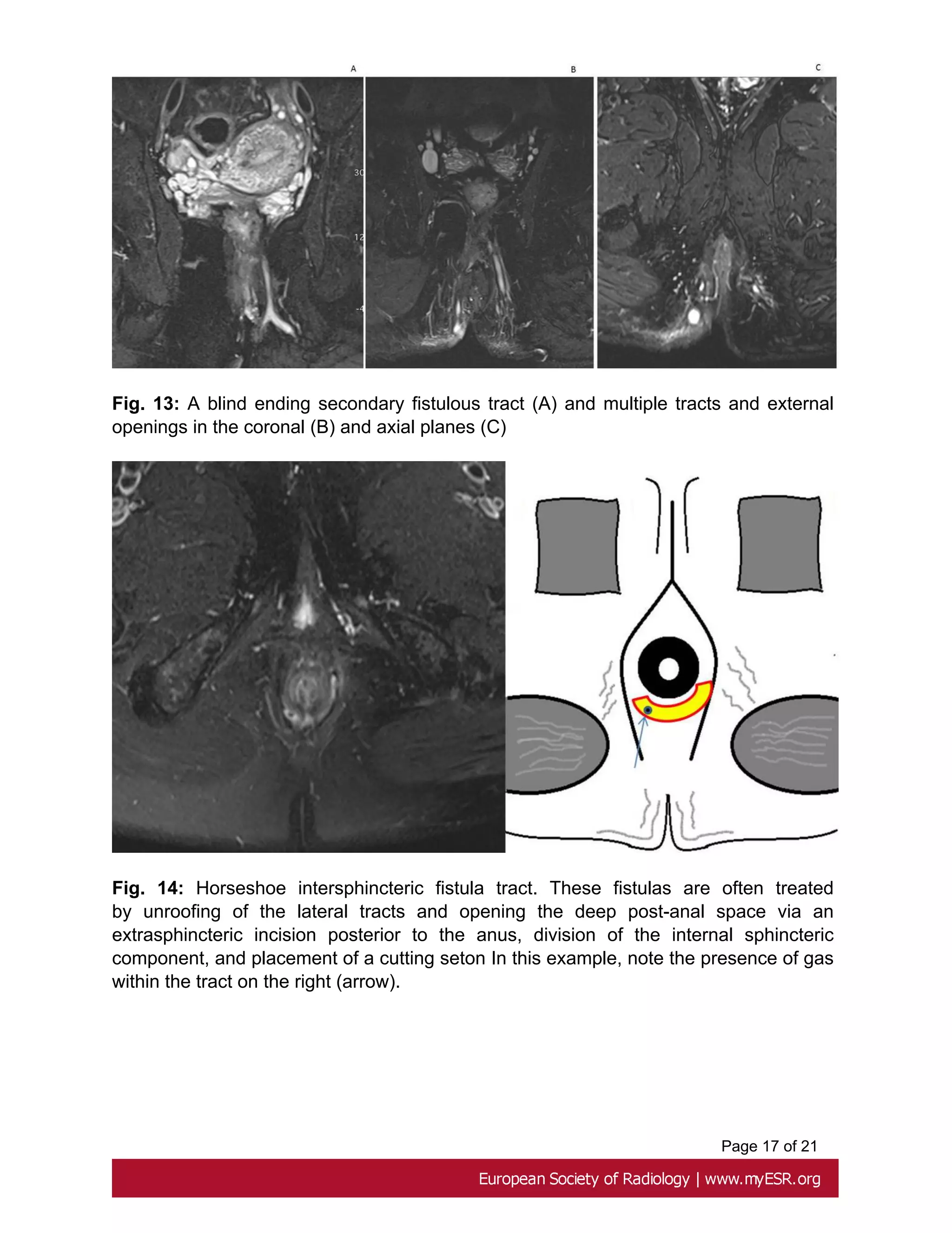 Perianal fistula on mri | PDF