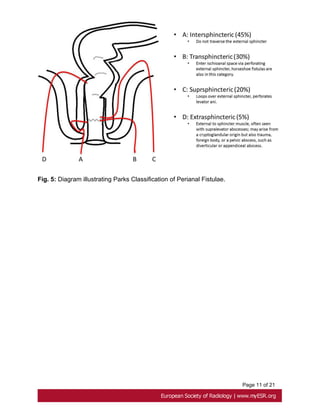 Perianal fistula on mri | PDF