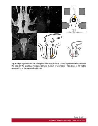 Perianal fistula on mri | PDF