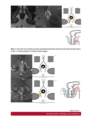 Perianal fistula on mri | PDF