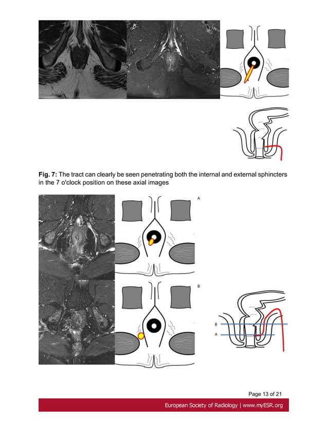 Perianal fistula on mri | PDF | Digestive Disorders | Diseases and ...