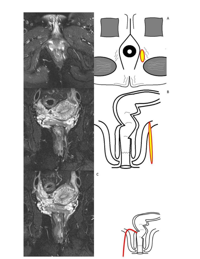 Perianal fistula on mri | PDF | Digestive Disorders | Diseases and ...
