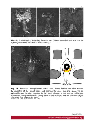 Perianal fistula on mri | PDF