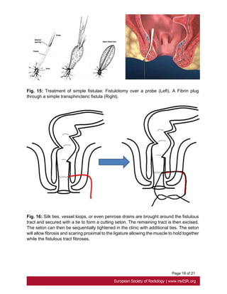 Perianal fistula on mri | PDF