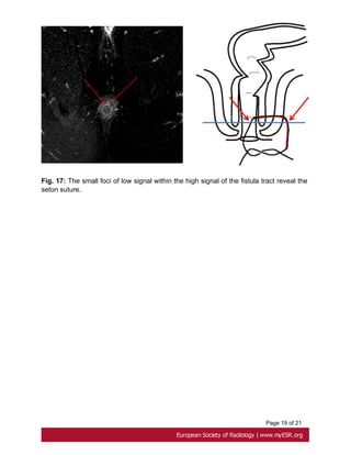 Perianal fistula on mri | PDF