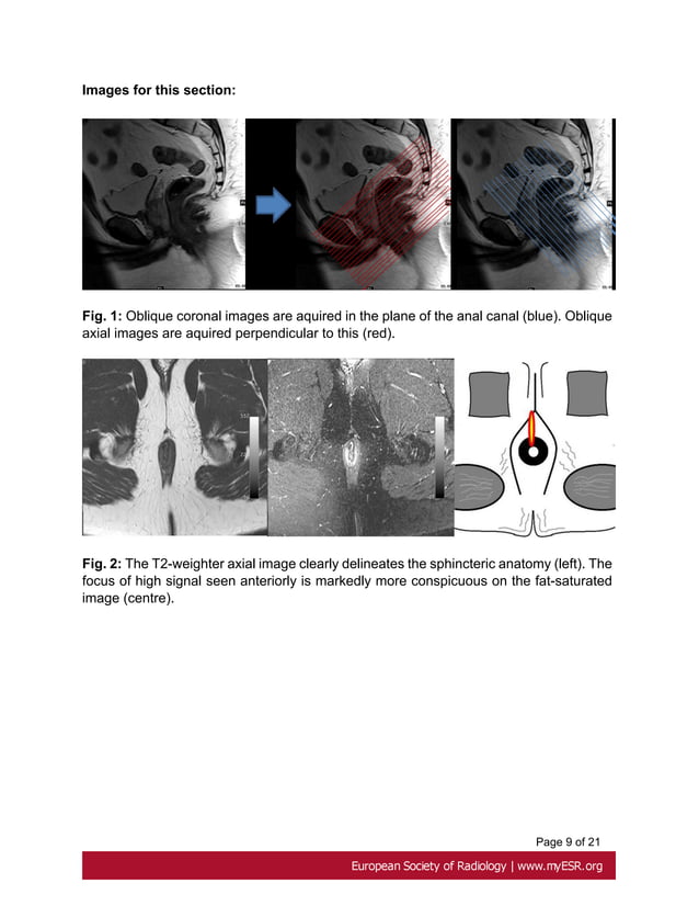 Perianal fistula on mri | PDF | Digestive Disorders | Diseases and ...