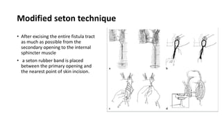 Perianal surgeris.pptx