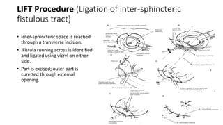 Perianal surgeris.pptx