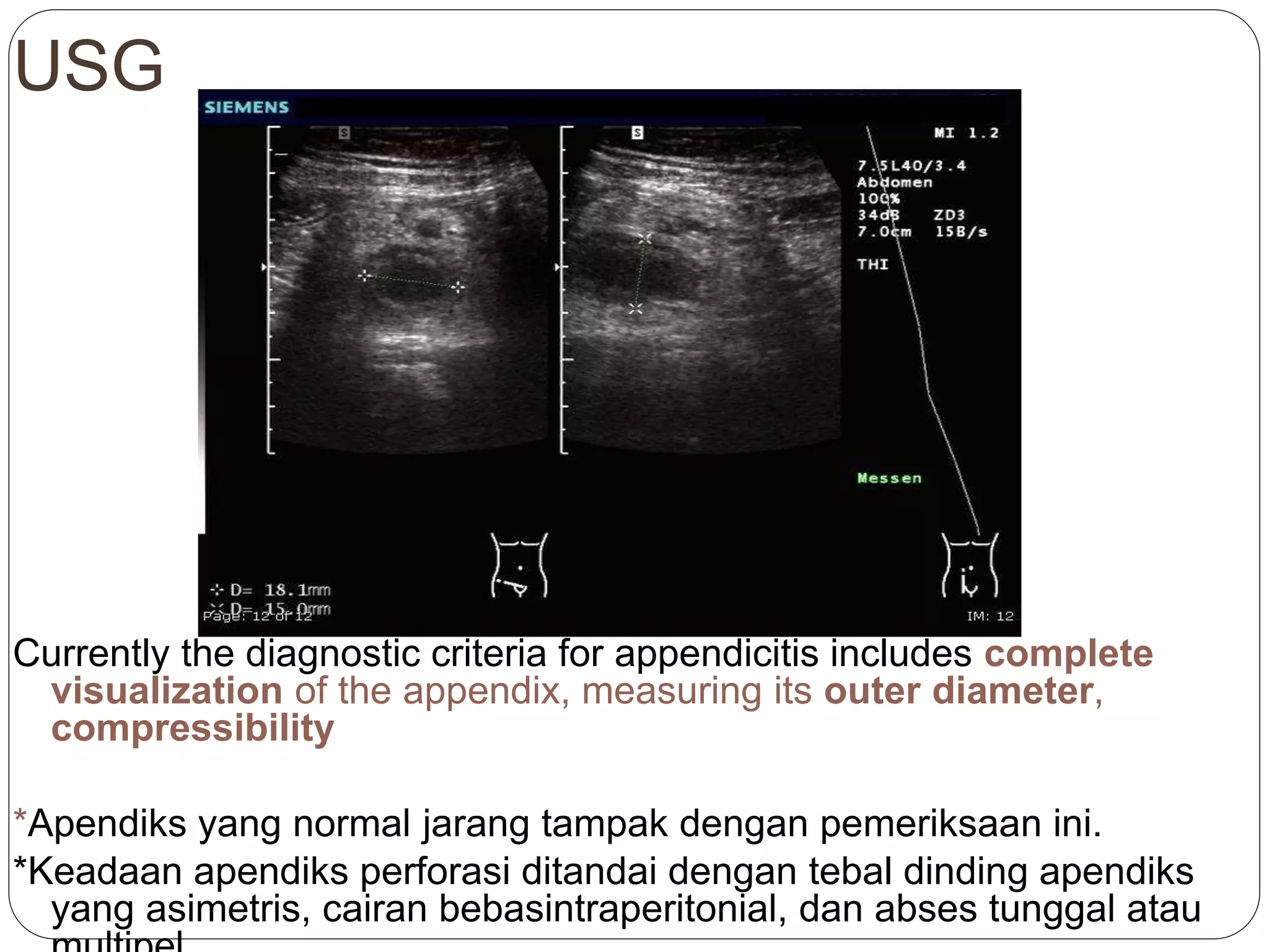 Peri apendikuler infiltrat | PPTX