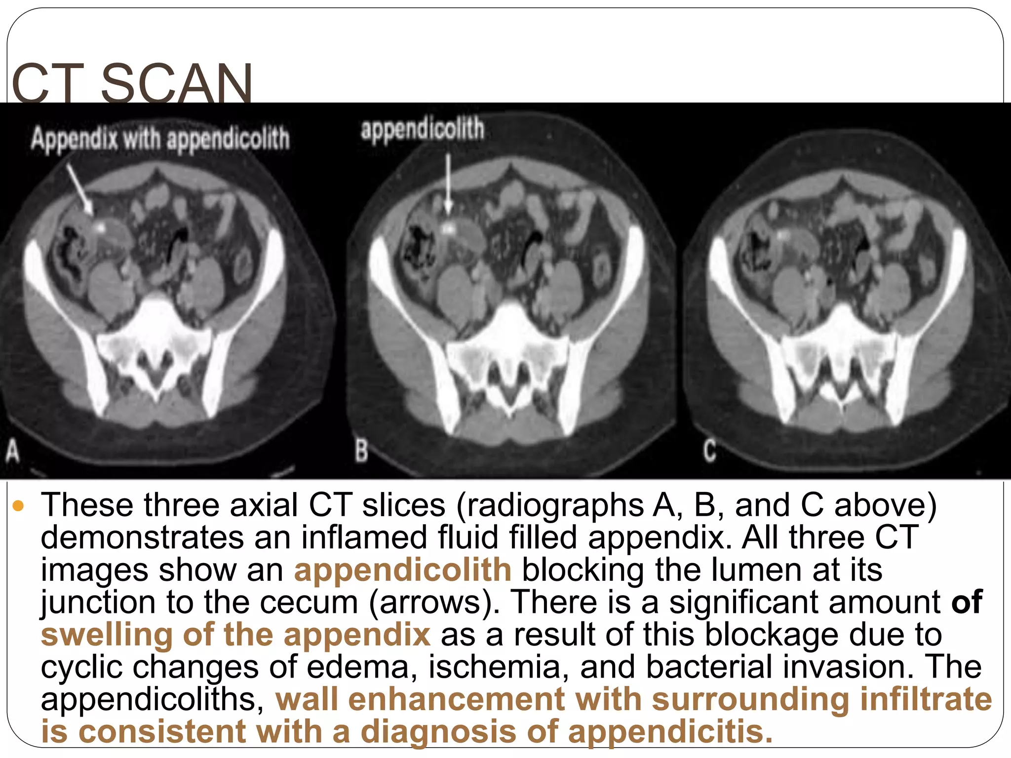 Peri apendikuler infiltrat | PPTX